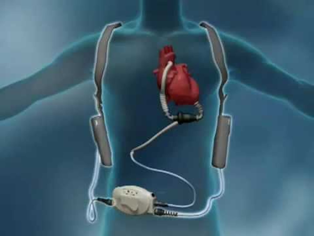 Abbott Recalls HeartMate II After 26 Deaths | Healthcare Packaging