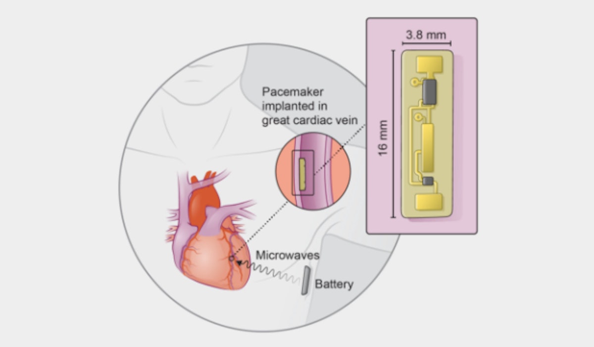 New Wireless Pacemaker is Powered by Microwaves | Healthcare Packaging